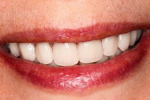 Gallery | Dental Lab in Annandale, VA