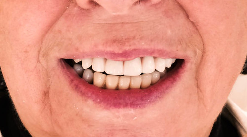 Gallery | Dental Lab in Annandale, VA