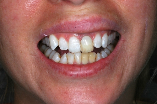 Gallery | Dental Lab in Annandale, VA