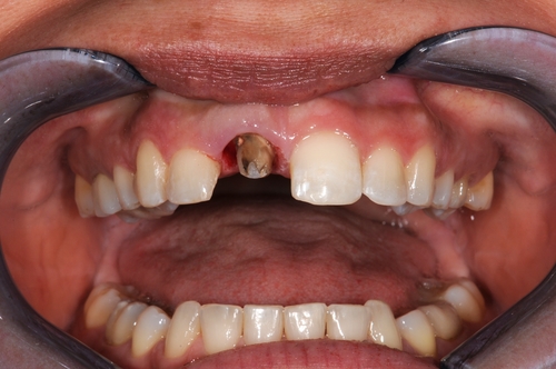 Gallery | Dental Lab in Annandale, VA