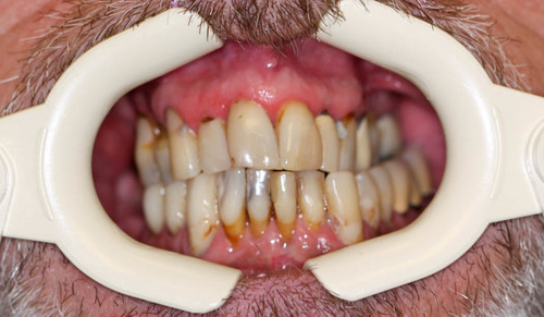 Gallery | Dental Lab in Annandale, VA