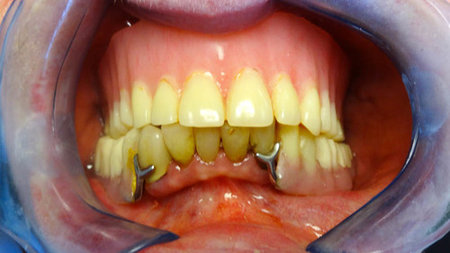 Gallery | Dental Lab in Annandale, VA