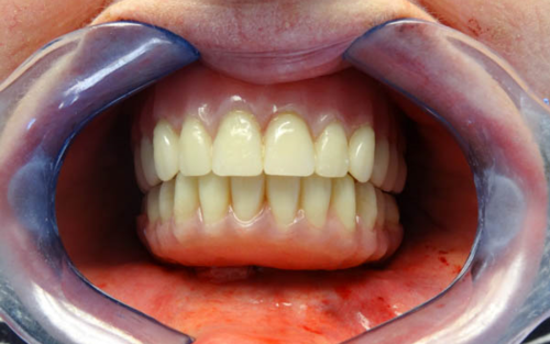 Gallery | Dental Lab in Annandale, VA