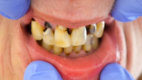 Gallery | Dental Lab in Annandale, VA