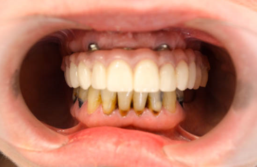 Gallery | Dental Lab in Annandale, VA