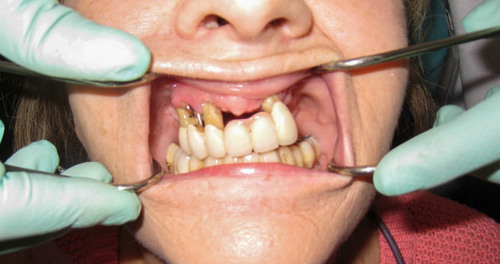 Gallery | Dental Lab in Annandale, VA