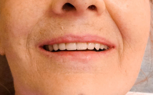 Gallery | Dental Lab in Annandale, VA