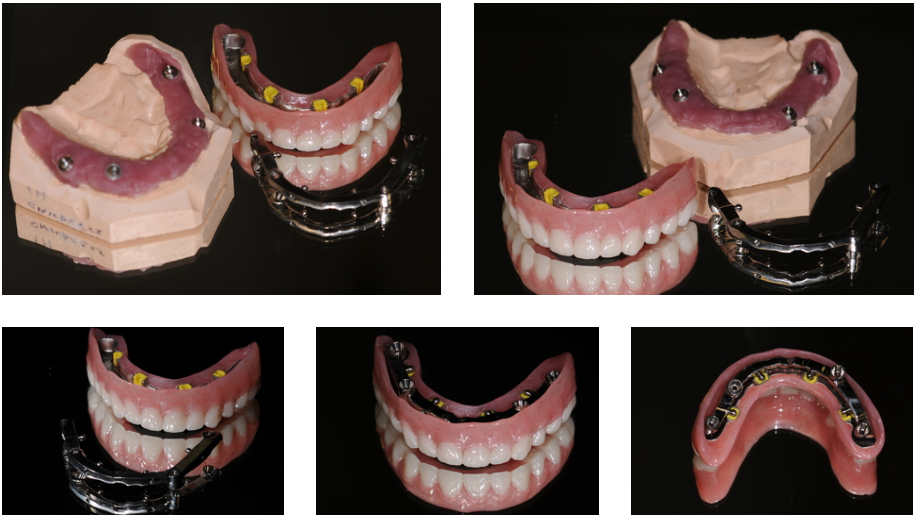 Gallery | Dental Lab in Annandale, VA